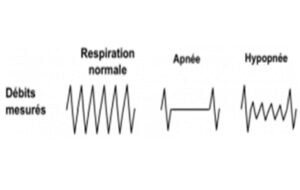 Polygraphie ventilatoire | Pathologies du sommeil et de la vigilance